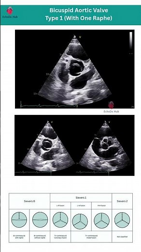 Bicuspid Aortic Valve – Type 1 (With One Raphe) #echocardiography #heartdisease