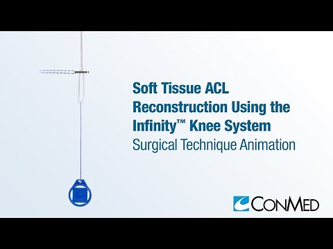 Soft Tissue ACL Reconstruction Using the Infinity™ Knee System - CONMED Animation