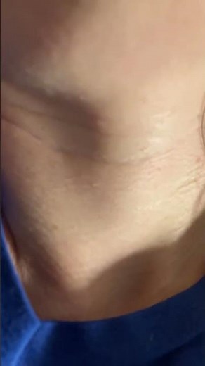 neck pulse visible heartbeat