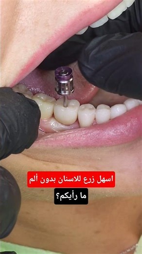 اسهل زرع للاسنان بدون الم