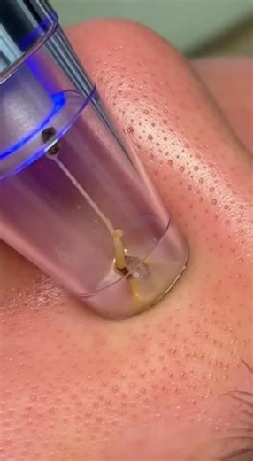 Watch This Ultra Satisfying Pore Extraction & Deep Skin Cleanse!