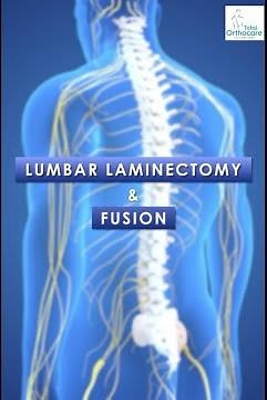 Your Guide to Lumbar Laminectomy & Fusion Surgery | Total Orthocare