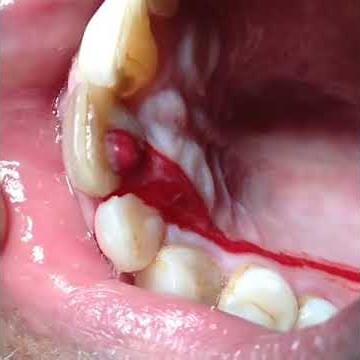 Drainage abscess through root canal