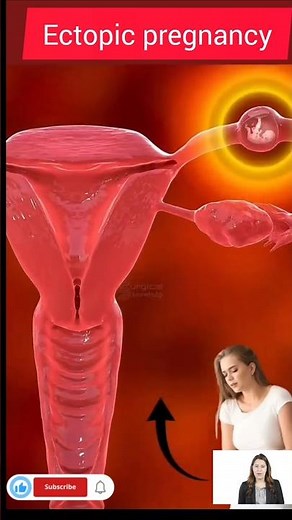 Ectopic Pregnancy Inside the Body | 3D Animation | Early Signs & Emergency Care #pregnant