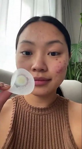 MASSIVE CYSTIC ACNE REMOVAL The Deepest Extractions Ever Seen 🤯