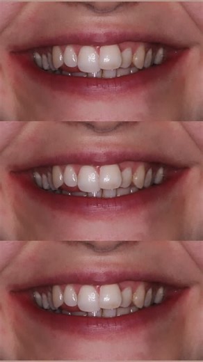 Invisalign ✅ whitening ✅ composite bonding ✅ 3 steps to your new smile. Contact us today to schedule your appointment 📆 #dental #invisalign #new | Enhance Dental Clinic