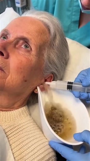 Understanding Earwax and Its Removal Techniques