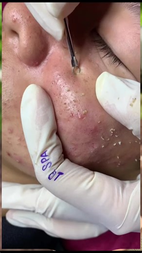 #acne #blackhead #pimple #blackheads #pimples #face