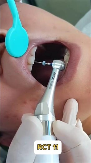 Root canal Treatment on 11 #dentist #shorts