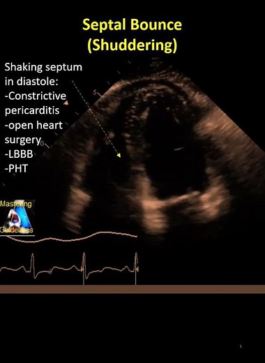 Septal Bounce (shuddering): constrictive pericarditis,... #education
