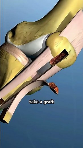 How a Torn ACL Is Rebuilt? (3D Animation) #aclrecovery #aclr #posteriorcruciateligament #aclrehab