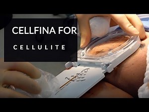 SEE HOW CELLFINA + SCULPTRA ELIMINIATE CELLULITE FOREVER ON THE LEGS AND BUTTOCK | DR. JASON EMER