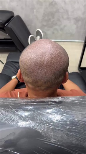 #smp #hairtreatment #scalpmicropigmentation #scalptreatment #balding