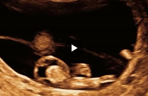 TRAP Sequence in Identical Twins: Rare Complication and Diagnosis | Rebecca Durante posted on the topic | LinkedIn