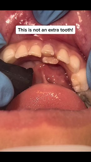 This is not an extra tooth⚠️ This is a permanent tooth which is not erupting into the correct position✅ It is coming out behind the baby teeth🦷 Sometimes the baby teeth need to be removed in order to make space for the permanent teeth to move into the correct position! #teeth #tooth #dentist