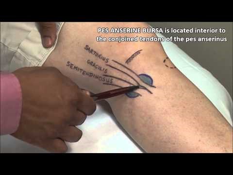 PES ANSERINE BURSITIS INJECTION: Step-By-Step Instructions