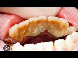 Massive hard calculus removal by dentist / Tartar removal by ultrasonic scaling #tartar #scaling