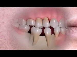 Following tooth loss - Jaw bone deterioration