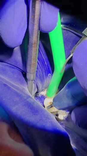 Effective Techniques for Removing Plastic Thermafil Carriers