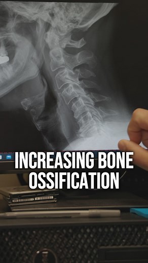 What does your neck X-ray really say about your health? 📸 In a healthy spine, your neck should form a smooth backward C-curve — perfectly balanced over your shoulders. But when the head shifts forward (a common posture problem today), that curve straightens or even reverses. The result? Forward head posture, disc degeneration, arthritis, and pinched nerves — all from carrying the weight of your head too far forward. Your posture isn’t just about appearance — it’s about pressure, alignment, and 