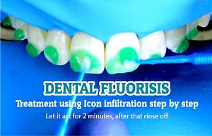 DENTAL FLUOROSIS: Treatment using Icon Infiltration Step by Step