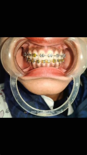 Rashid dental clinic #orthodontictreatment #orthodontist #extraction #braces #karachi #azozabad