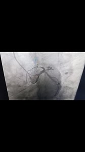 2.9K views · 18 reactions | Based on this angiographic view, what would be your next step in management? #cardiology #coronaryangiogram #fbreelsfypシ゚viralシ #fbreelsfypシ゚viralfbreelsfypシ゚viral #highlights2025 #highlightseveryone Heart Centre Heart Practical Interventional Cardiology Dr Tutan Das - Your Interventional Cardiologist Cath Lab Professional Cardiac Eman Manzvanzvike | Heart Centre | Facebook