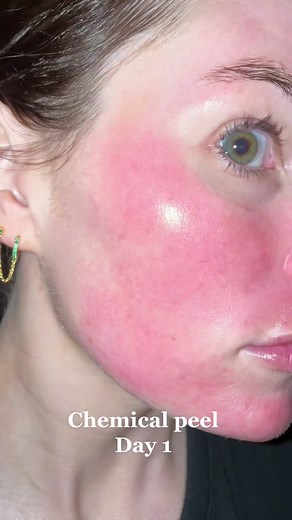 Transform Your Skin with a Chemical Peel Journey