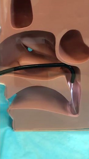 Fish bone removal using a therapeutic endoscope