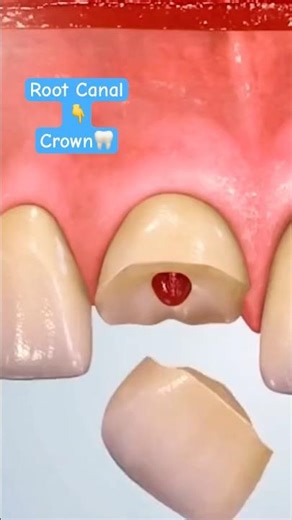 Broken tooth 👉Root Canal 👉Crown