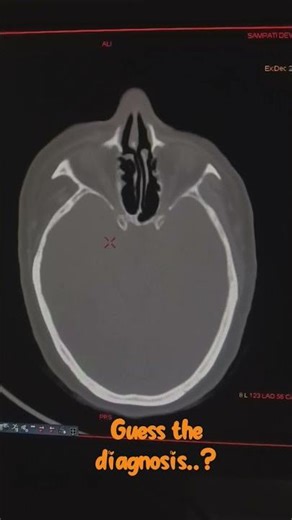 bone window ncct head #anatomy #image #radiographer #radiology #radio #medical #medicalcareer