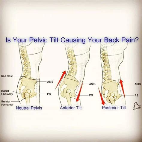 Posterior Pelvic Tilt Cause Symptom Treatment Exercise
