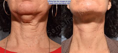 Lifting du visage Cou Facelift Necklift Avant Après Photos