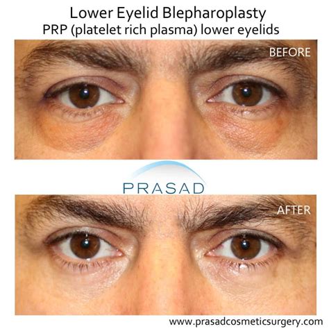 Benefits Of PRP Injection Under Eyes Dr Prasad New York
