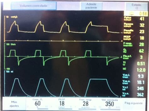 Ventilación controlada por volumen y mecánica ventilatoria básica