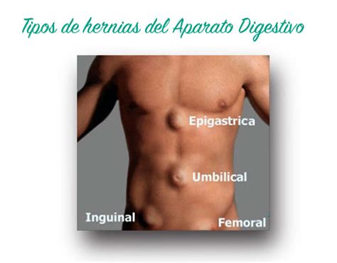 Hernias Tipos Síntomas Y Tratamientos Iocir Free Download Nude Photo
