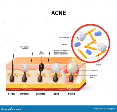 Acne Vulgaris Or Pimple And Normal Skin Cross Section Of Human Skin