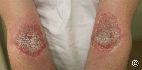 Hailey Hailey Disease