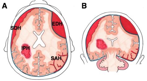 Subdural Vs Epidural Hematoma Raeannartin