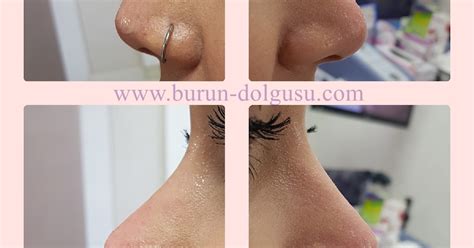 Burun Dolgusu Fiyatı 2022 Güncellendi