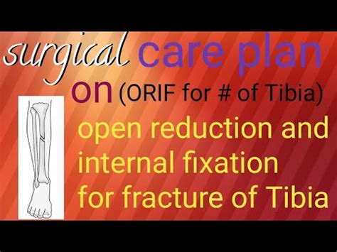 Surgical Care Plan On Open Reduction And Internal Fixation For Fracture