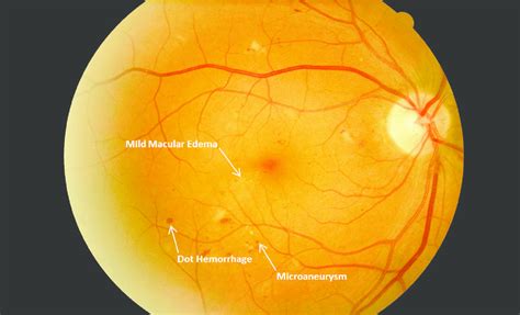 Moderate Non Proliferative Diabetic Retinopathy With Mild Diabetic
