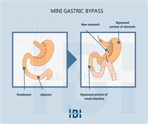 Mini Gastric Bypass Surgery OAGB IBI Weight Loss Center