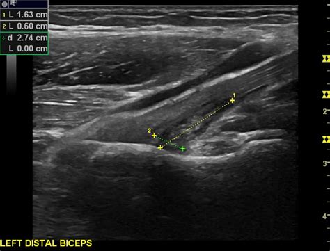Distal Biceps Rupture Ultrasound
