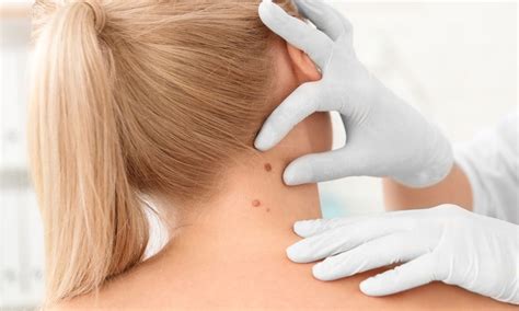 Seborrheic Keratosis Face How To Treat Seborrheic Keratosis