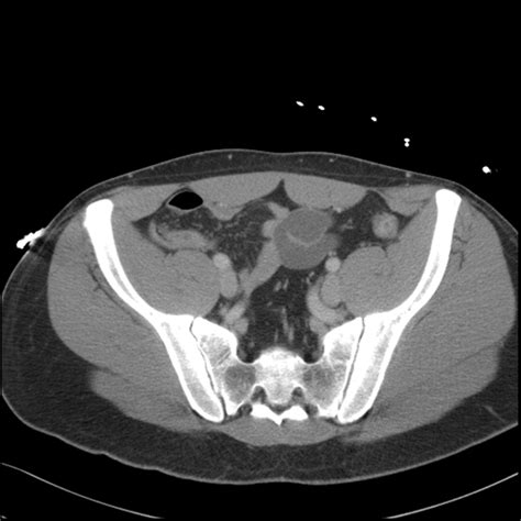 Muscles Of Pelvis Ct Anatomy