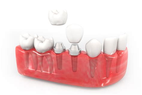 Implantes o puentes dentales cuál es la mejor opción Clínica