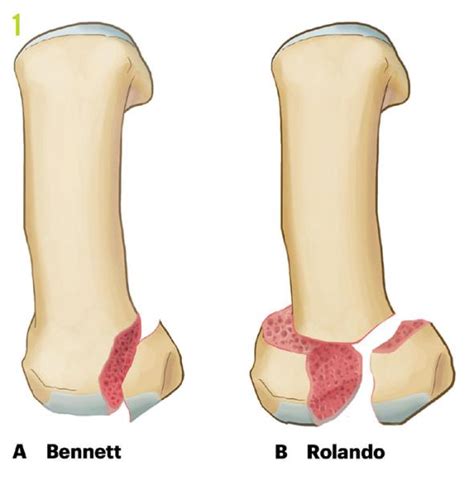 Bennett Fracture Wikism Sports Medicine Wiki