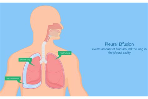 Pleural Effusion Treatment