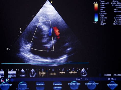 Ecocardiograma Doppler Color Cardiolog A Deportiva
